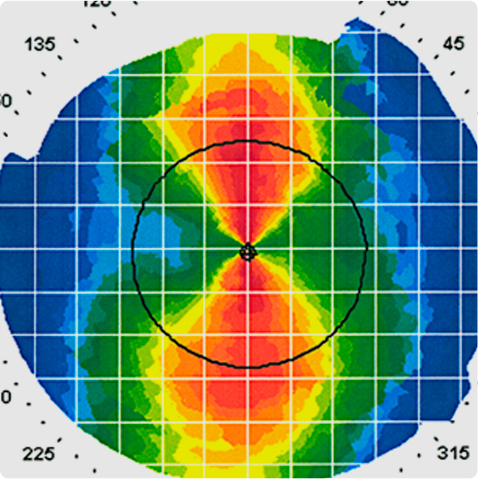 Topografia Corneana Normal